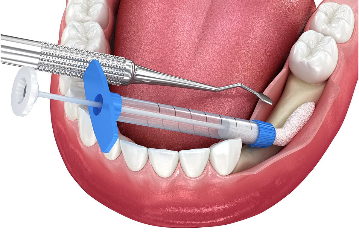How Much Does Bone Grafting Cost in Orange Park, FL?