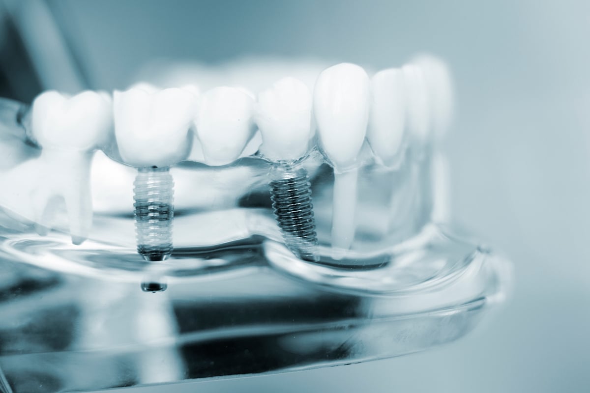 Getting Dental Implants? Here’s Everything You Need to Know - Oral ...
